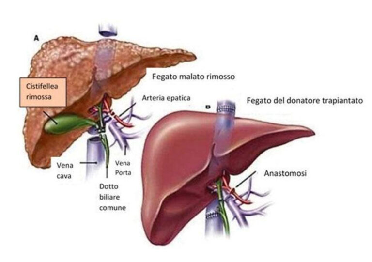 Il trapianto di fegato - Milan Criteria